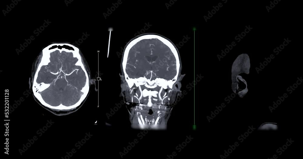 CTA Brain or Computed tomographic angiography of cerebral artery 2D ...