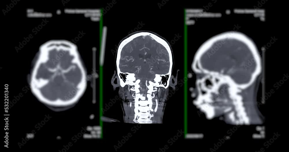 CTA Brain or Computed tomographic angiography of cerebral artery 2D ...