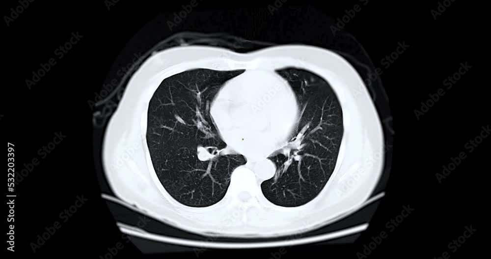 CT Chest or CT Scan of Lung used filter lung window for diagnosis TB,tuberculosis and ...