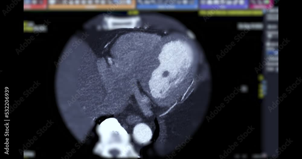 CTA Coronary artery for diagnosis of vessel coronary artery disease ...