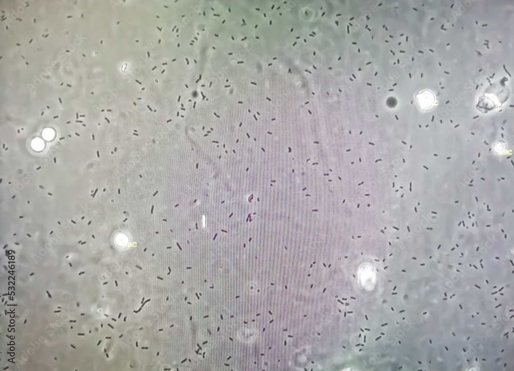 Microscopic image of abnormal urinalysis. urine exam. Urine routine ...