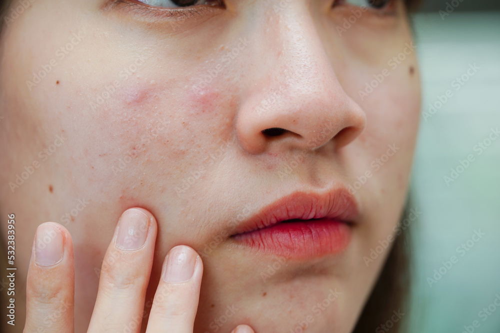 Acne pimple and scar on skin face, disorders of sebaceous glands ...