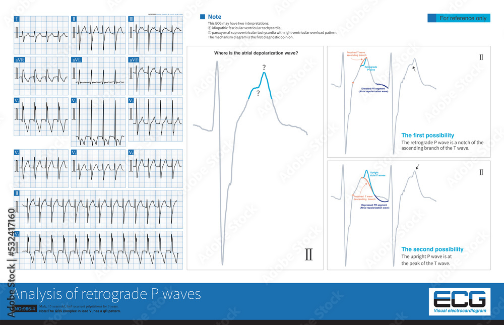 During An Episode Of Tachycardia Retrograde P Waves Can Overlap Any