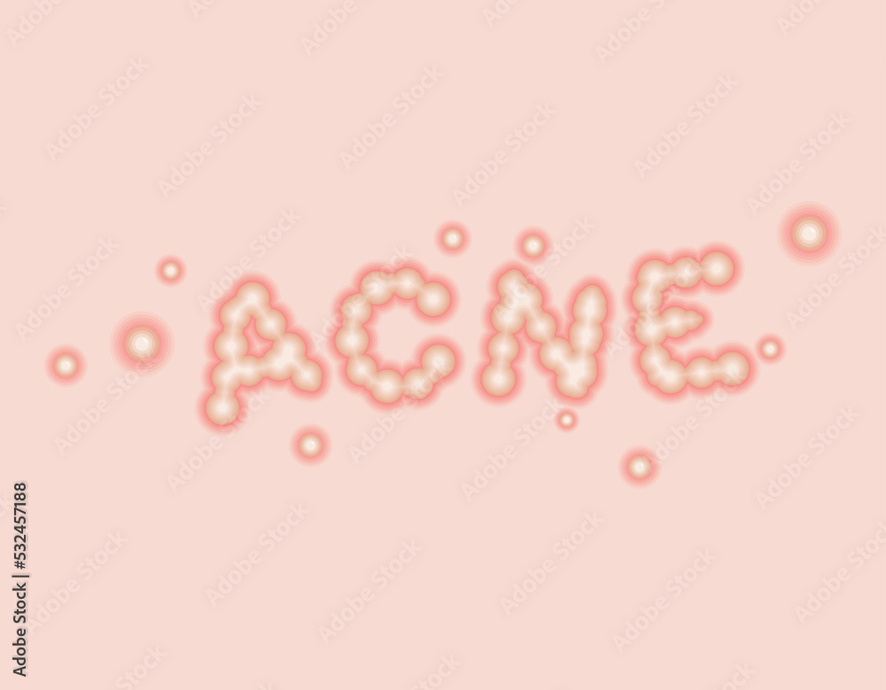 Acne lettering. Pimple lettersTypography. whelk typography Vector ...