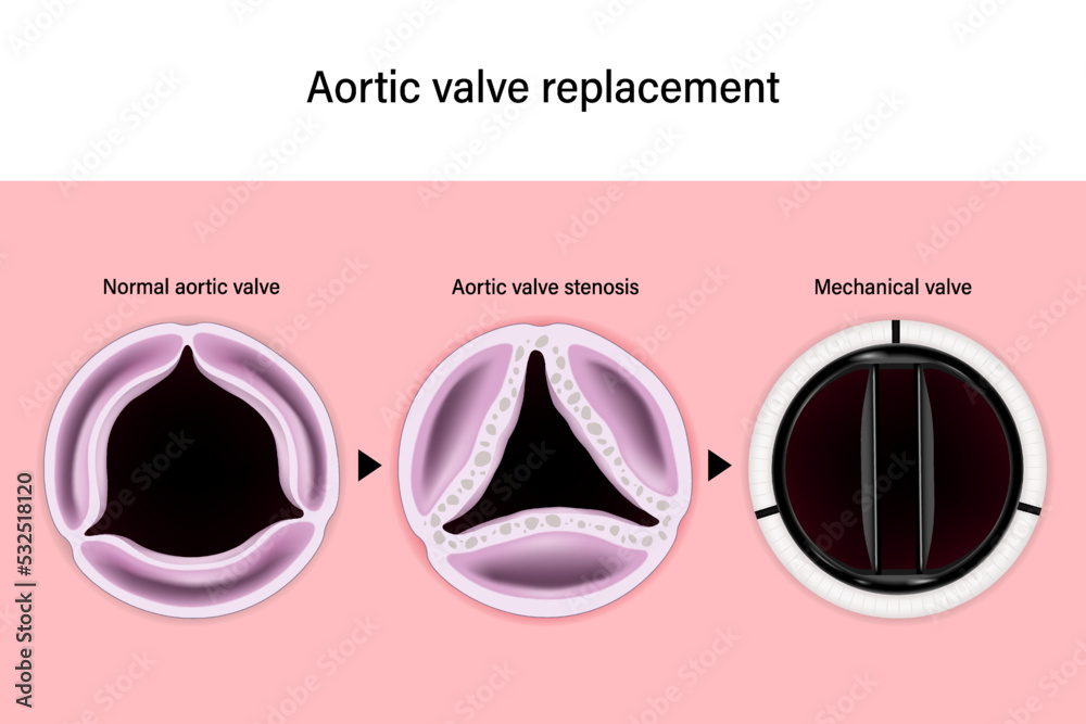 Aortic Valve Replacement Normal Aortic Valve Aortic Valve Stenosis