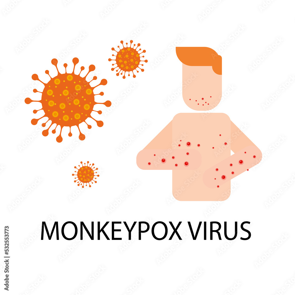 Monkey pox virus, rash on human skin. Vector illustration Stock ...