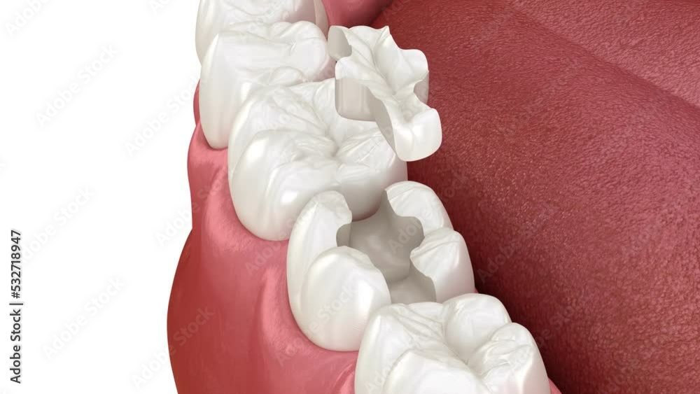 Inlay ceramic crown placement. Medically accurate 3D animation Stock ...