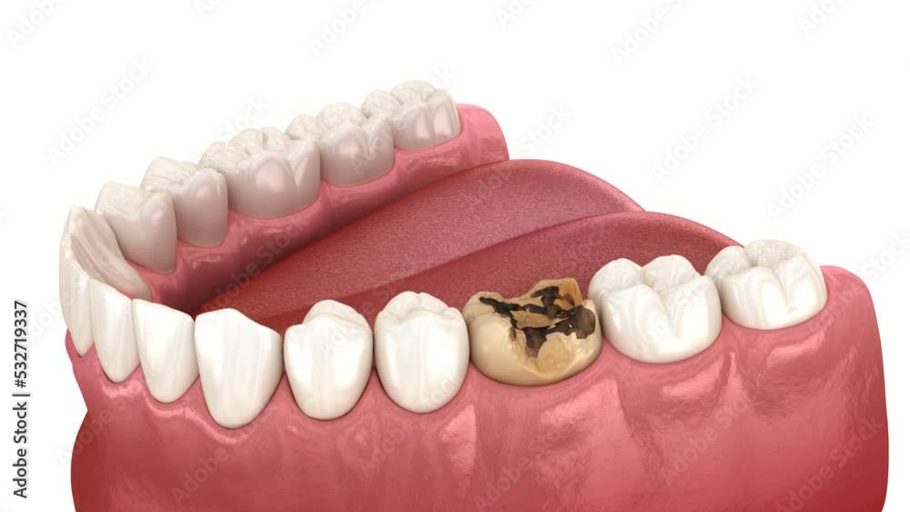 Caries removing, preparation, dental impression and crown placement. 3D ...