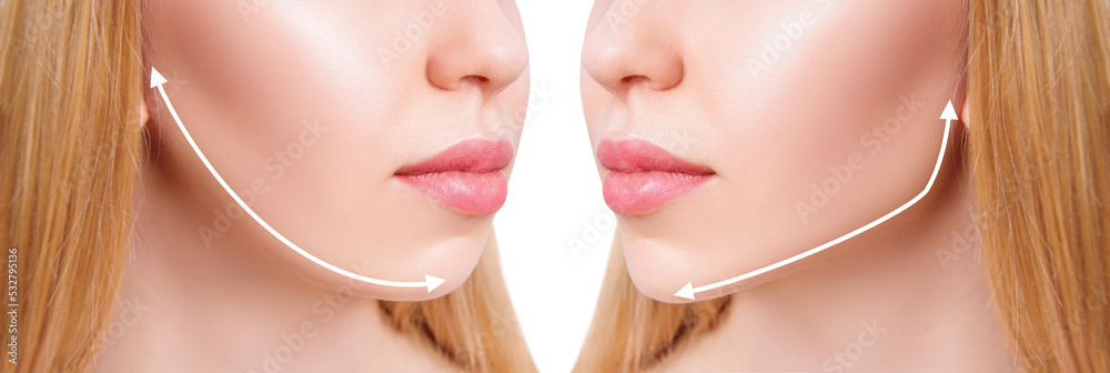 Woman before and after cheekbones shape correction. Stock Photo | Adobe ...