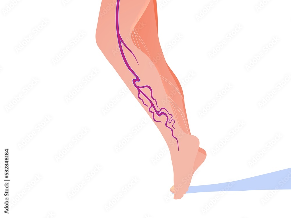 3d illustration of the venous system with varicose veins in one leg ...