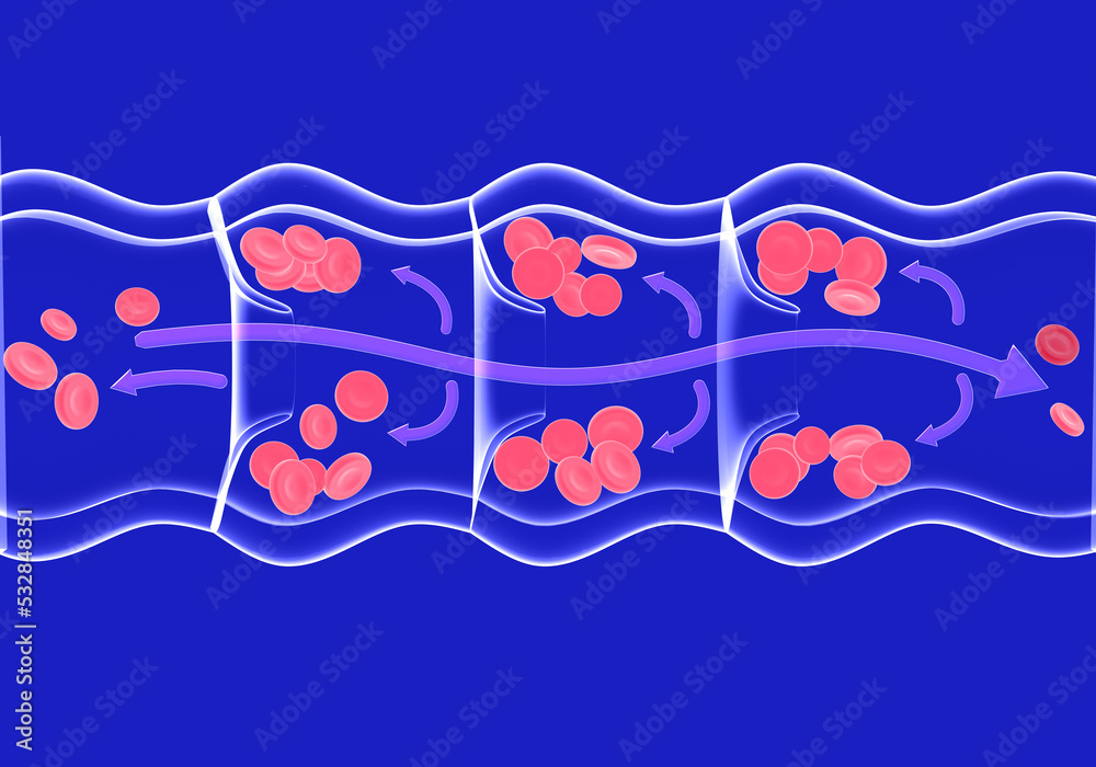 Anatomical 3d illustration of blood circulation in an incompetent ...