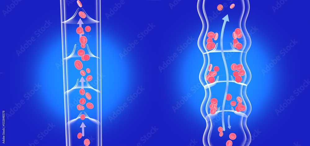 Anatomical 3d illustration of two images, diseased incompetent vein ...