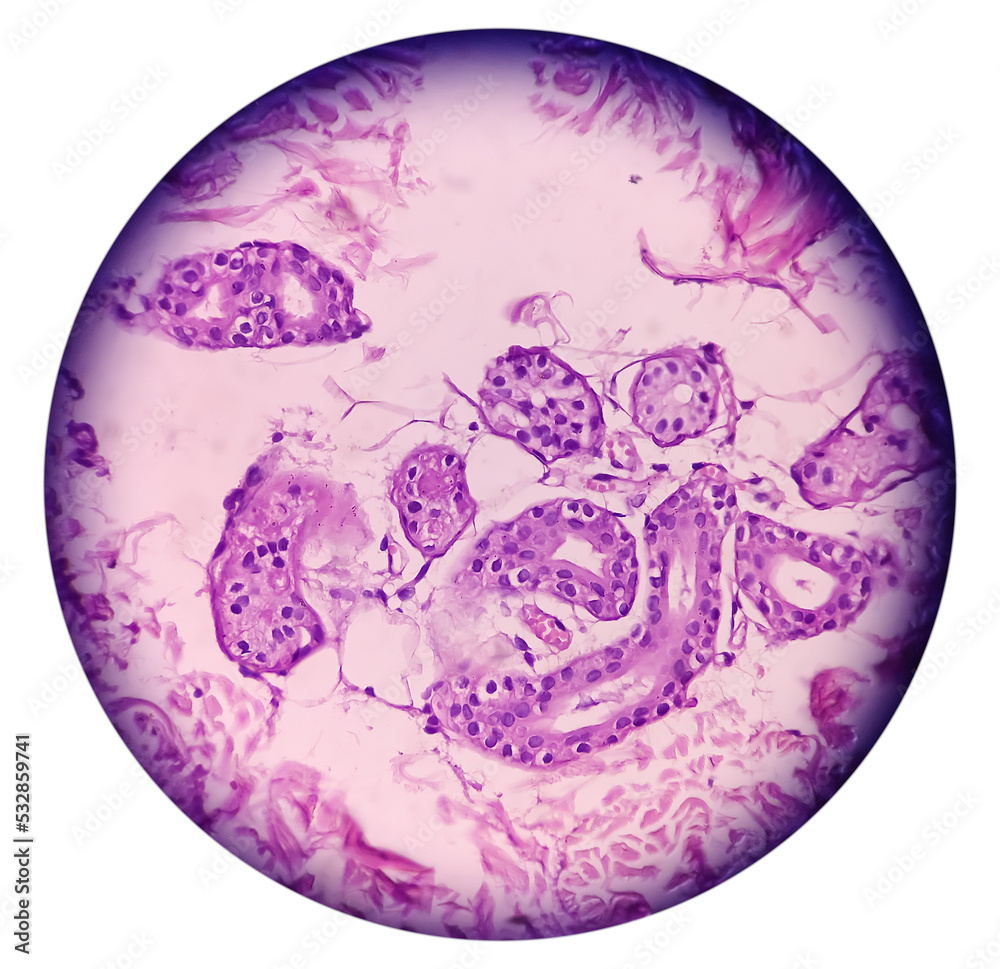 Skin tissue(biopsy): Pityriasis lichenoids chronica, a group of rare ...