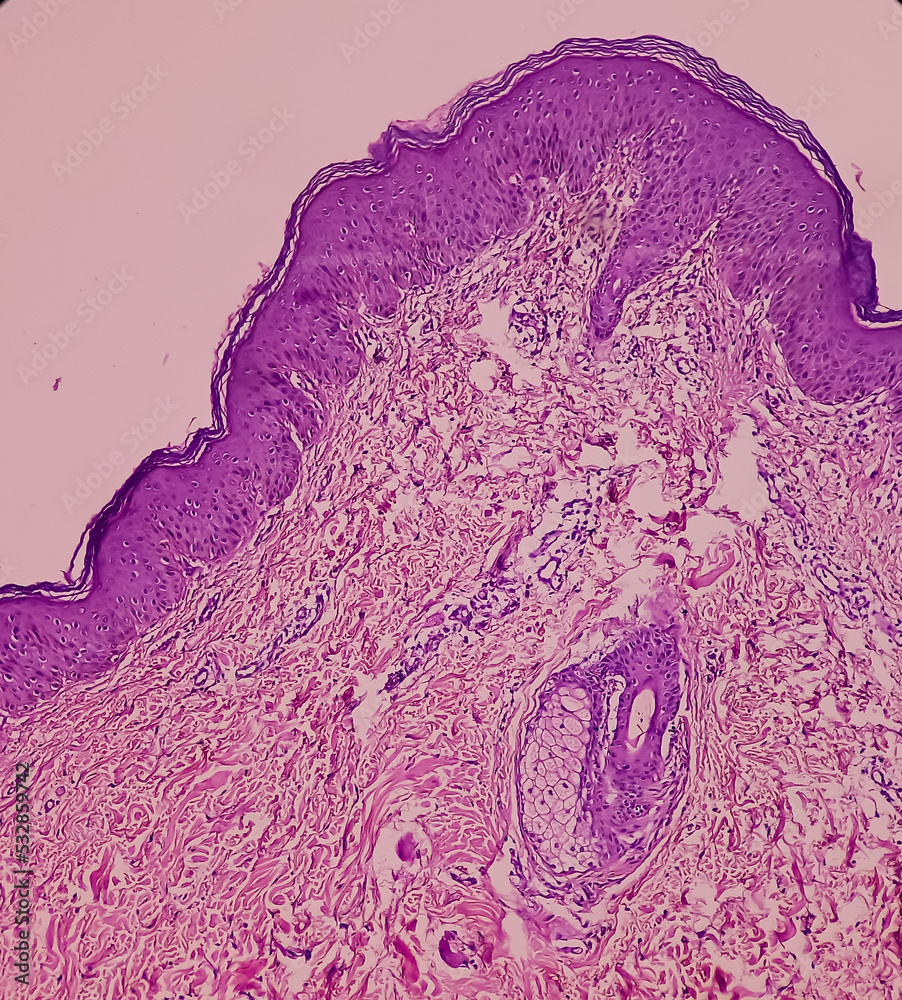 Skin tissue(biopsy): Pityriasis lichenoids chronica, a group of rare ...