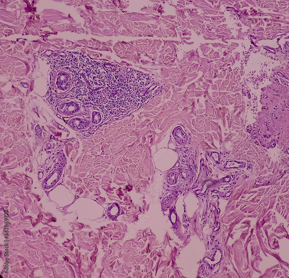 Skin tissue biopsy: Lichen planus. show skin tissue, hyperplastic ...