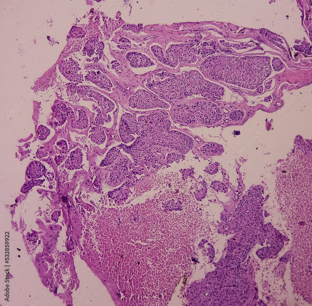 Punch Biopsy of face skin: face skin carcinoma, pigmented basal cell ...