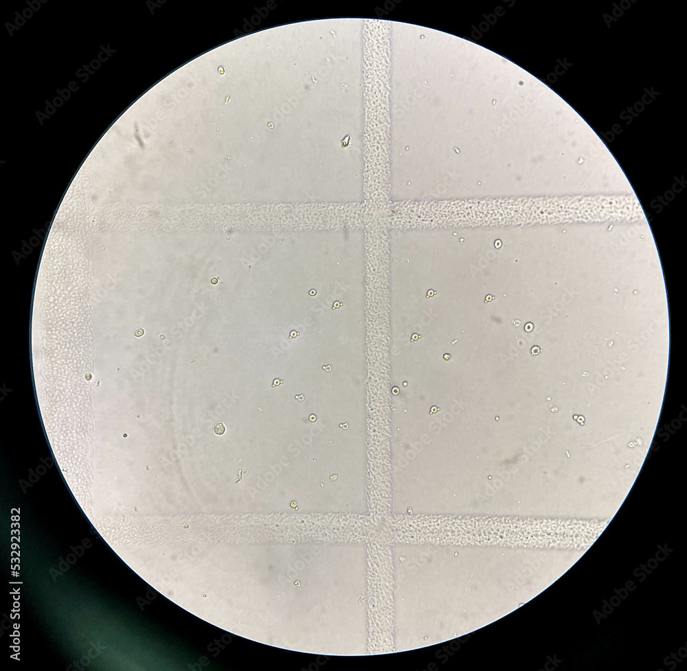 Dysmorphic urinary RBCs have been regarded as an indicator of ...