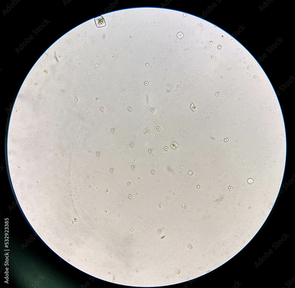 Dysmorphic urinary RBCs have been regarded as an indicator of ...