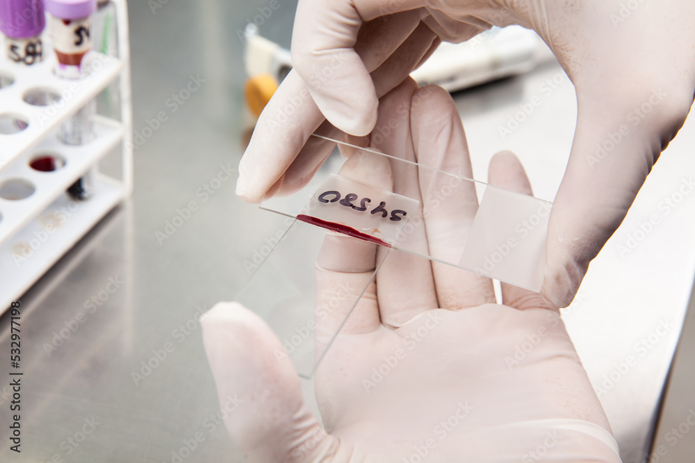 Scientist preparing a bone marrow smear in the laboratory. Blood smear ... Scientist preparing a bone marrow smear in the laboratory. Blood smear ...