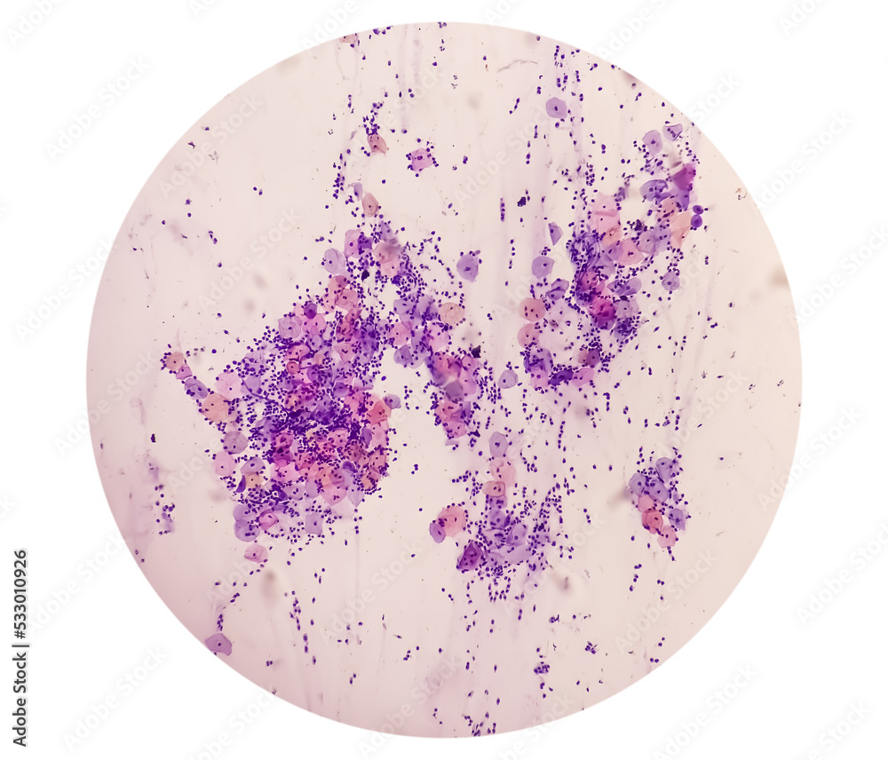 Microscopic view of PAP'S smear showing severe negative for ...