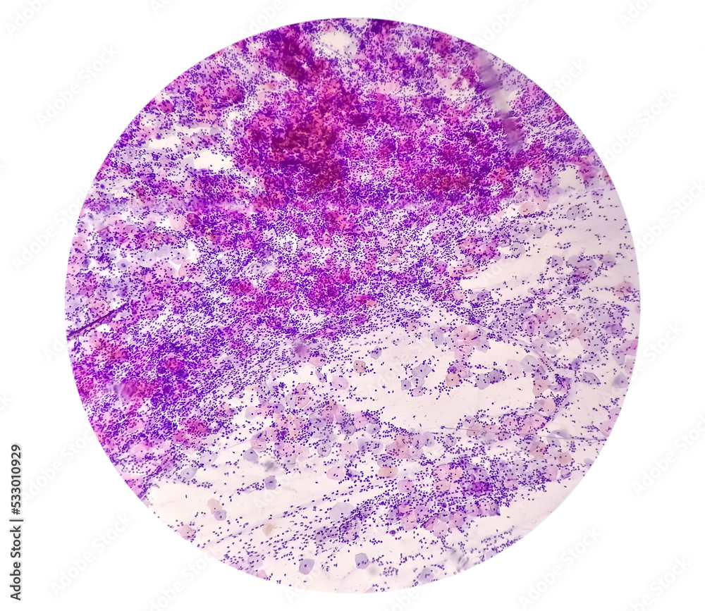 Microscopic view of PAP'S smear showing severe negative for ...