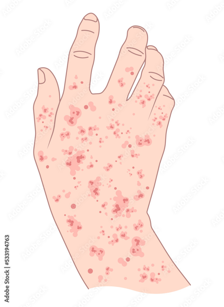 Hand reddish purple spots Decreased complete low platelet count ...