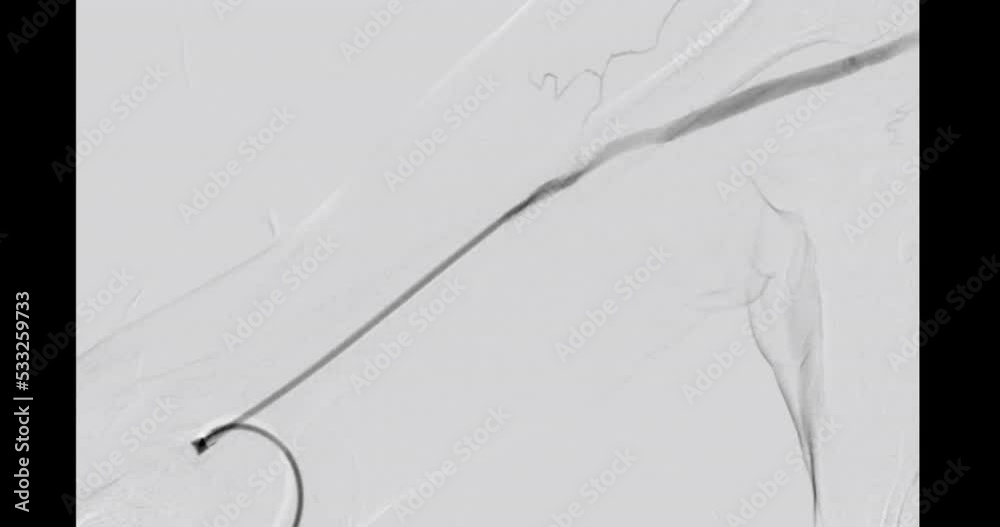 Angiogram balloon dialysis catheter inflated at Arteriovenous (AV ...