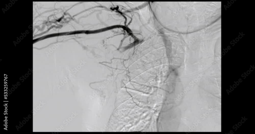 Angiogram balloon dialysis catheter inflated at Arteriovenous (AV ...