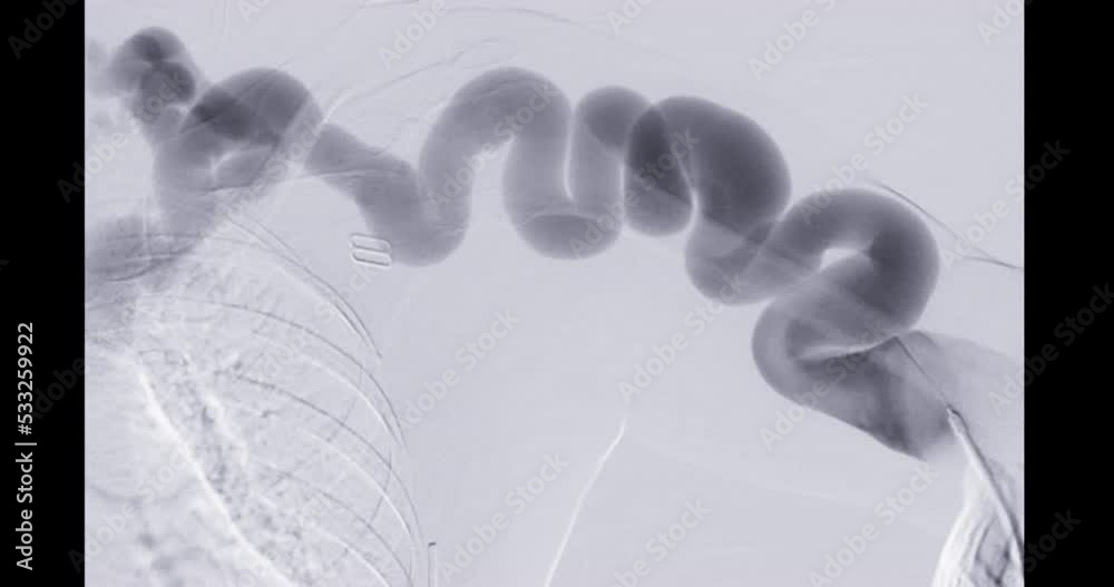 Angiogram balloon dialysis catheter inflated at Arteriovenous (AV ...