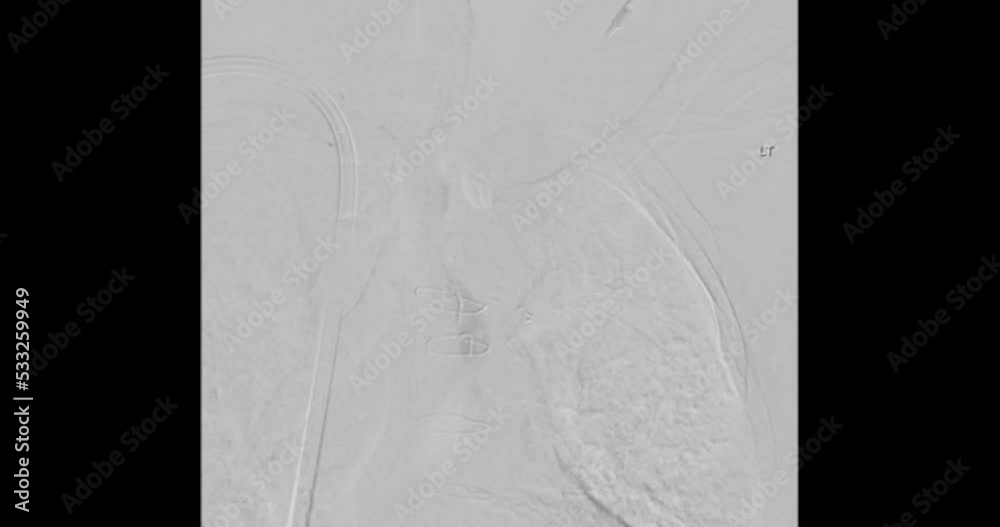 Angiogram balloon dialysis catheter inflated at Arteriovenous (AV ...