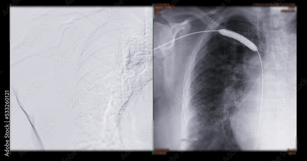 Angiogram balloon dialysis catheter inflated at Arteriovenous (AV ...