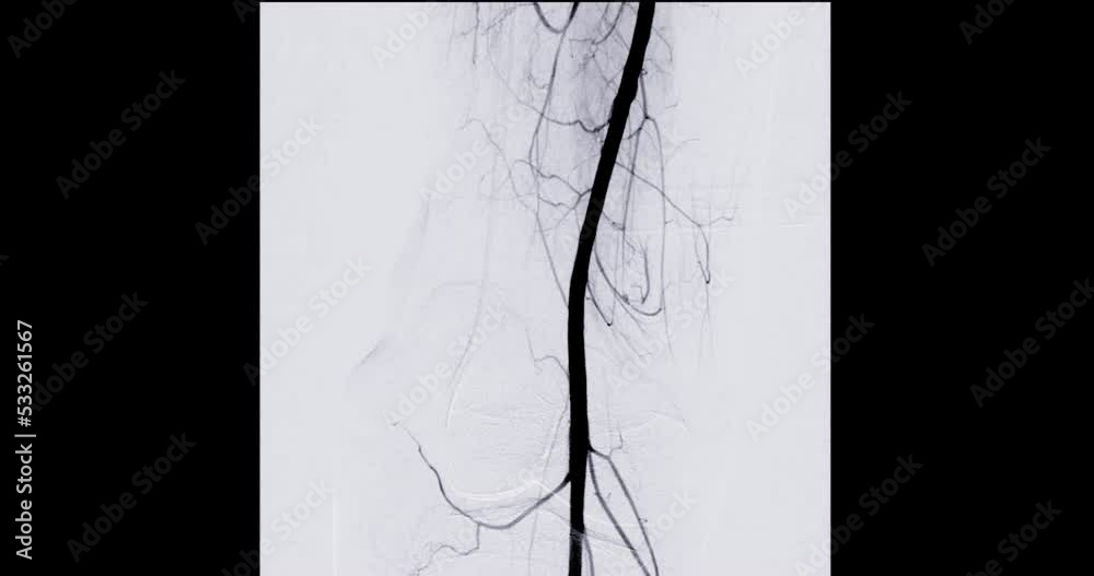 Femoral Angiogram of femoral artery showing femoral artery vessel ...