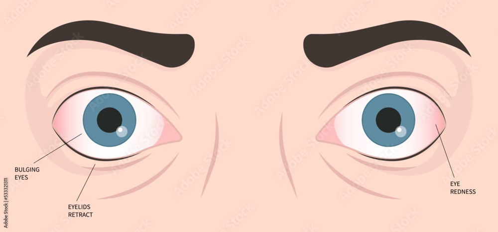 eye swollen with Hashimoto's thyroiditis and Graves' disease tumor ...