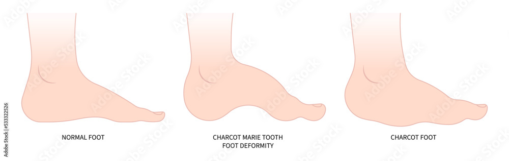 Fototapeta Side view the Charcot foot anatomy painful and diabetic gout ...