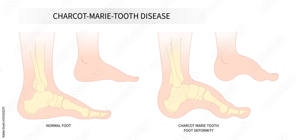 The arches foot anatomy painful leg and diabetic gout disease sores and ...