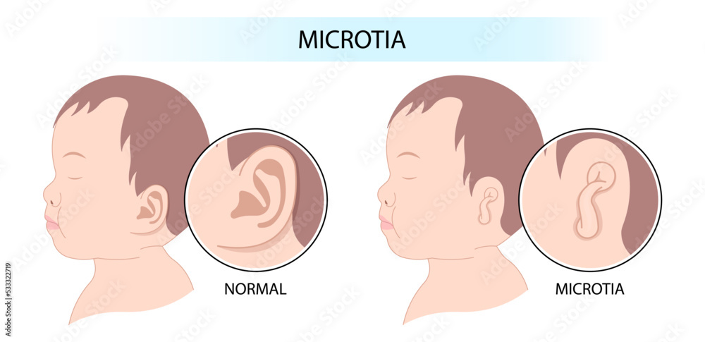 Photo & Art Print Before and after surgery of Abnormal shape with ...