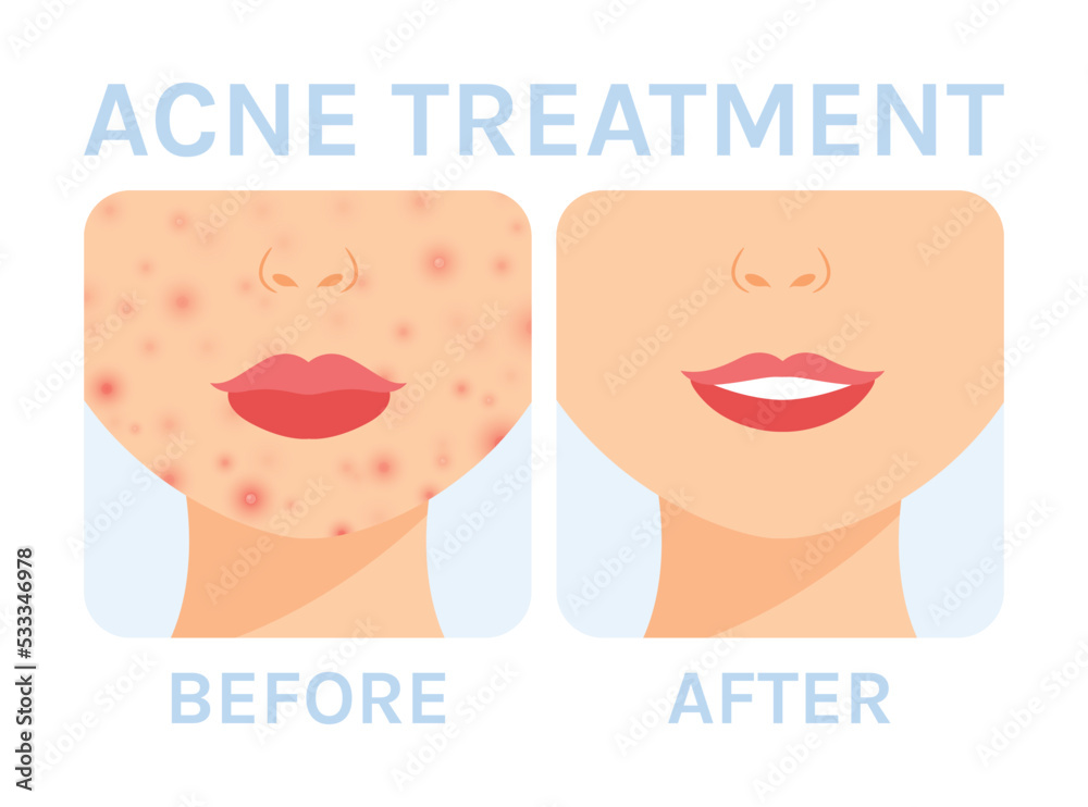 Pimples on a Woman Face. Treatment of Acne on Cheeks and Chin. Before ...