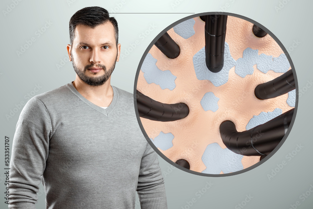 Fungal disease of the skin, dandruff on the scalp. An enlarged image of ...