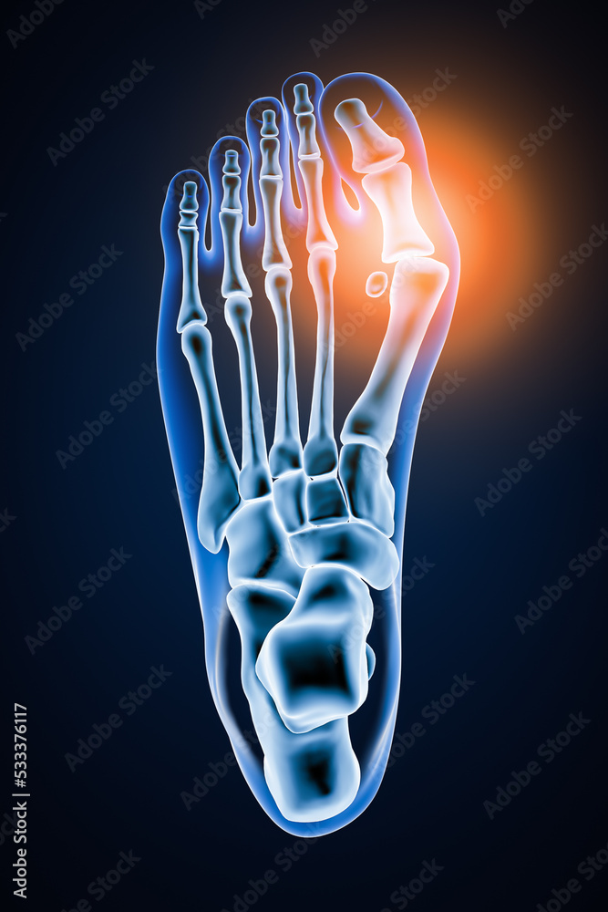 Hallux Valgus or bunion 3D rendering illustration. Superior or dorsal ...