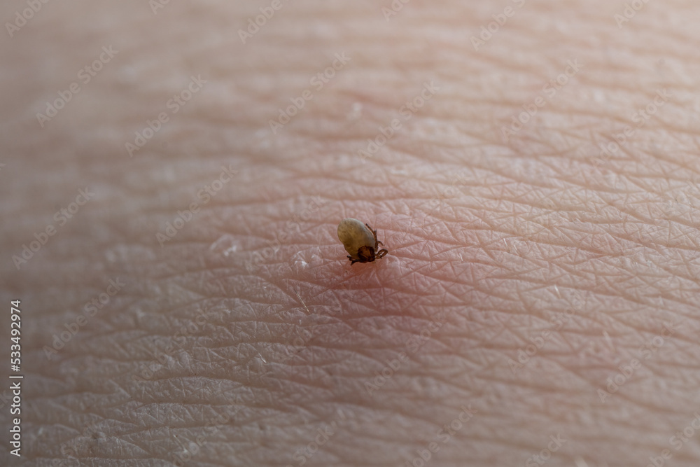 Sucking a tick Macro photo on human skin. Ixodes ricinus. The swollen ...