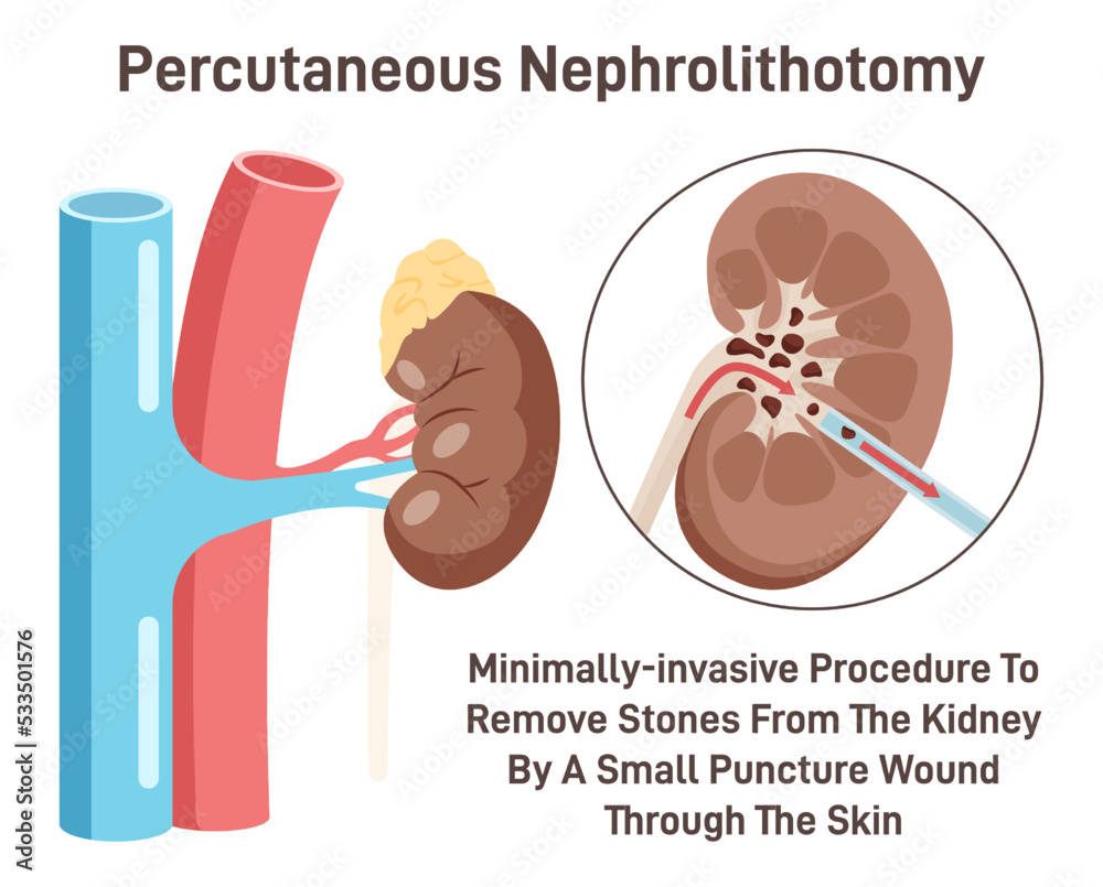 Percutaneous Nephrolithotomy Procedure
