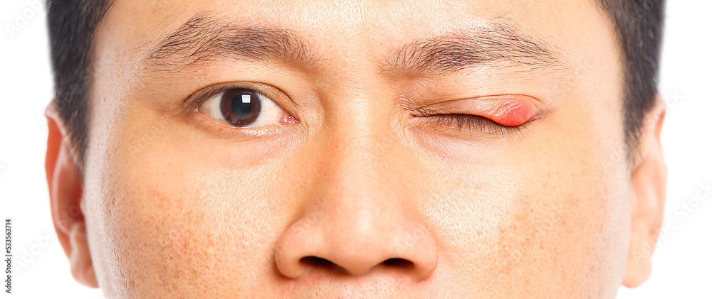 stye on the people eye. bacterial infection in the eyelid. Stock Photo ...