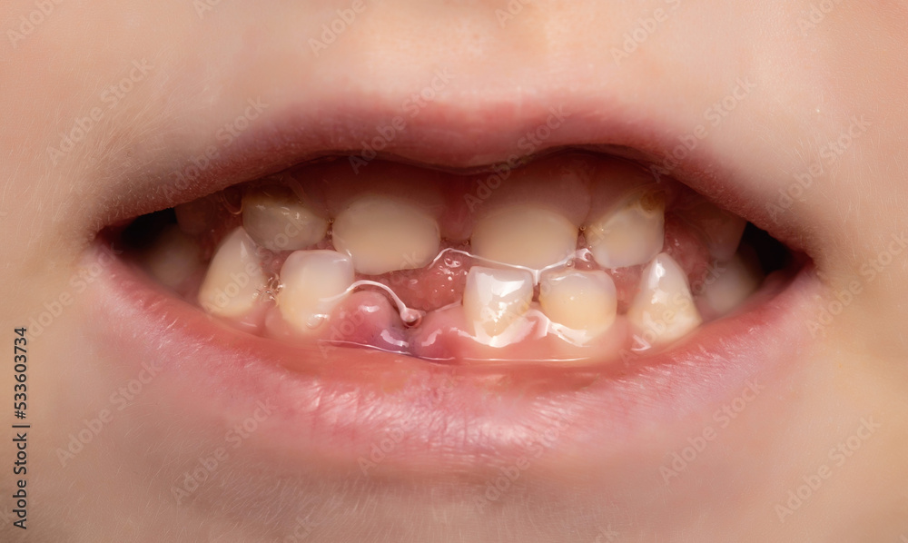 Beautiful smile of a child without one tooth. Change of milk teeth ...
