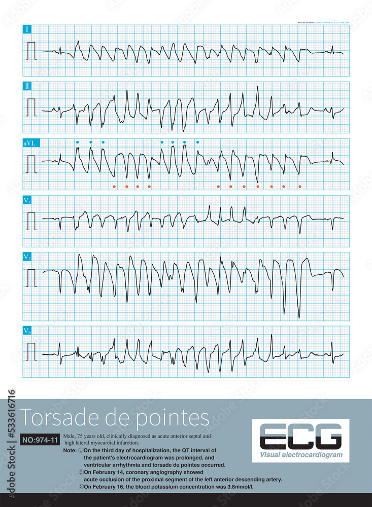 During an episode of torsade de pointes, the polarity of the QRS ...
