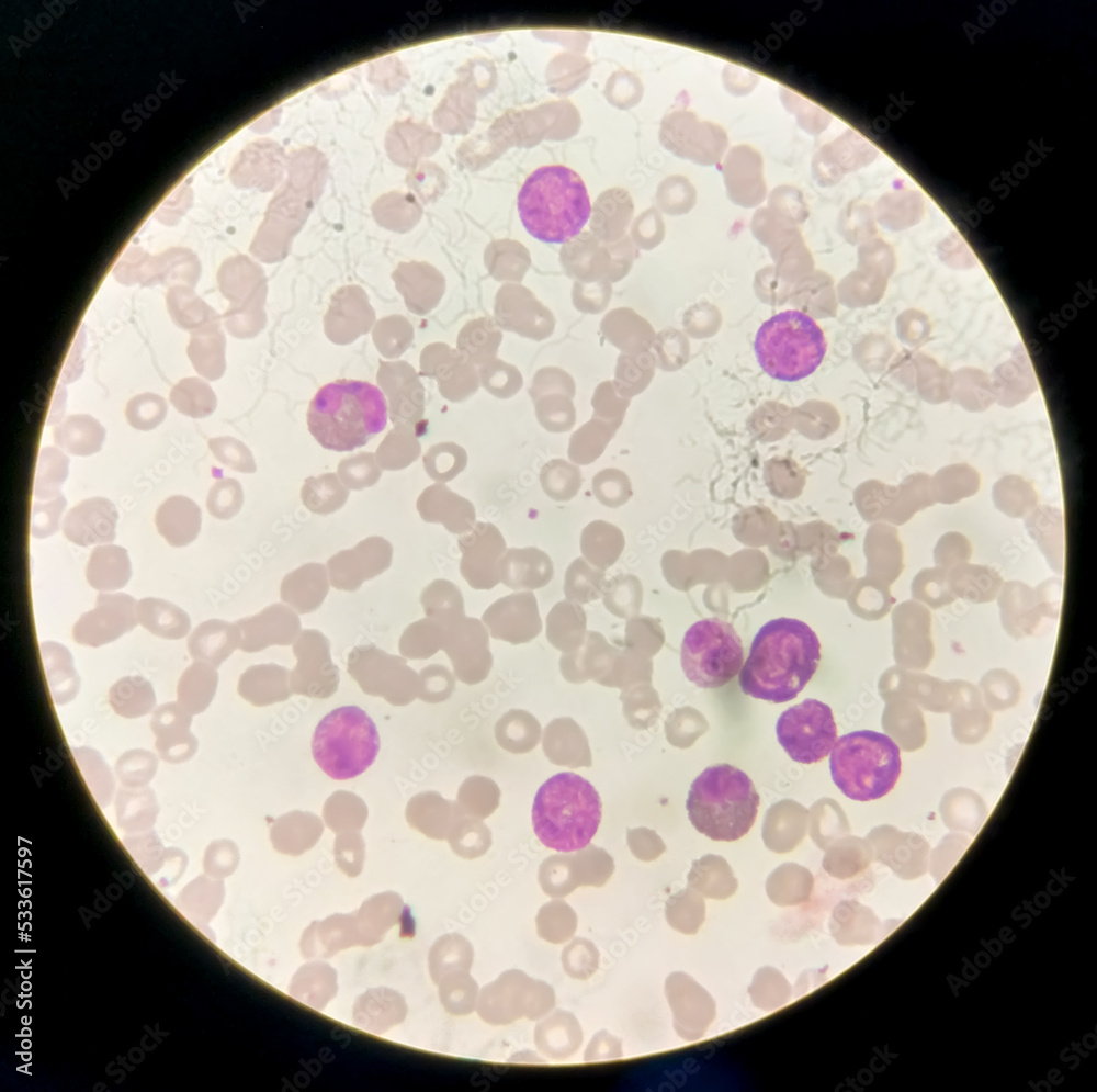 Acute myeloid leukemia (AML) is a type of blood cancer. Microscopic ...