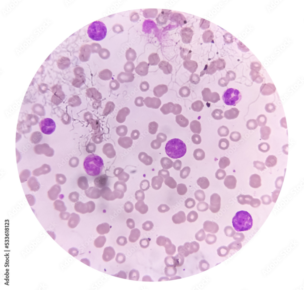 Photomicrograph of Acute Myeloblastic Leukemia (AML), a cancer of white ...