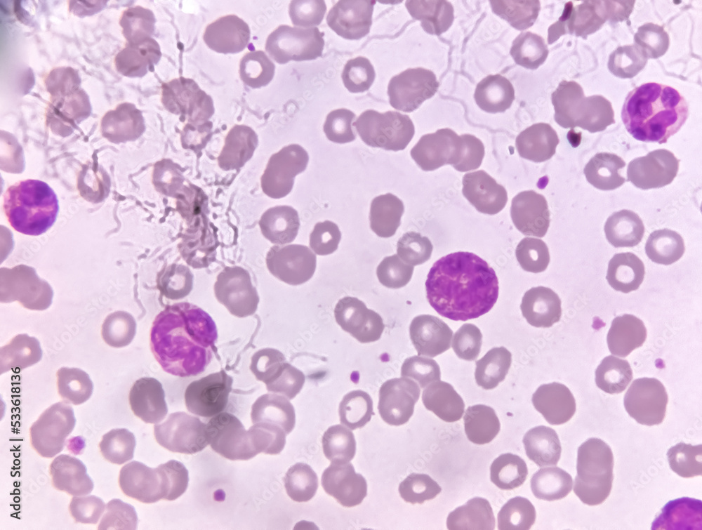 Photomicrograph of Acute Myeloblastic Leukemia (AML), a cancer of white ...