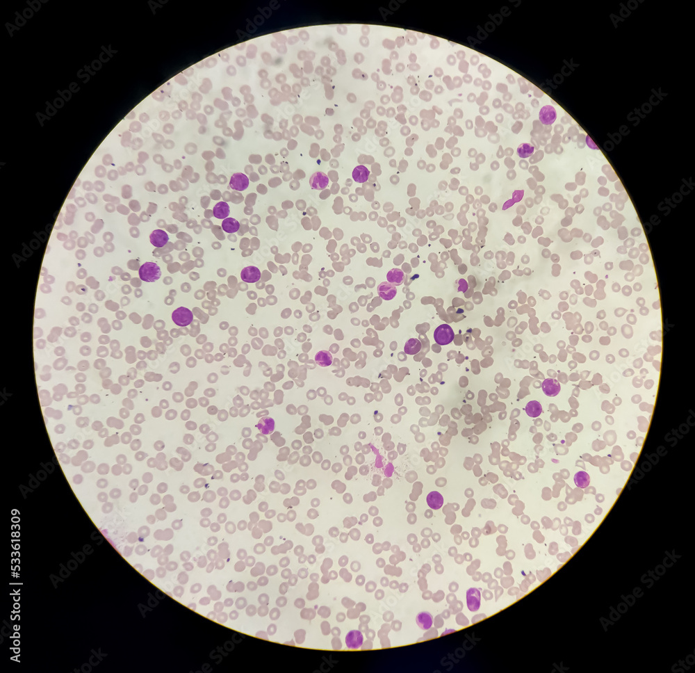 Microscopic image showing Chronic myeloid leukaemia (CML) is a type of ...