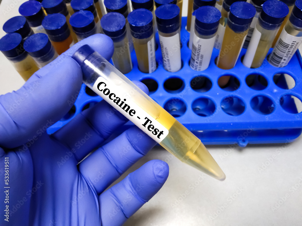 Urine specimen for doping drugs test of marijuana and cocaine. To ...