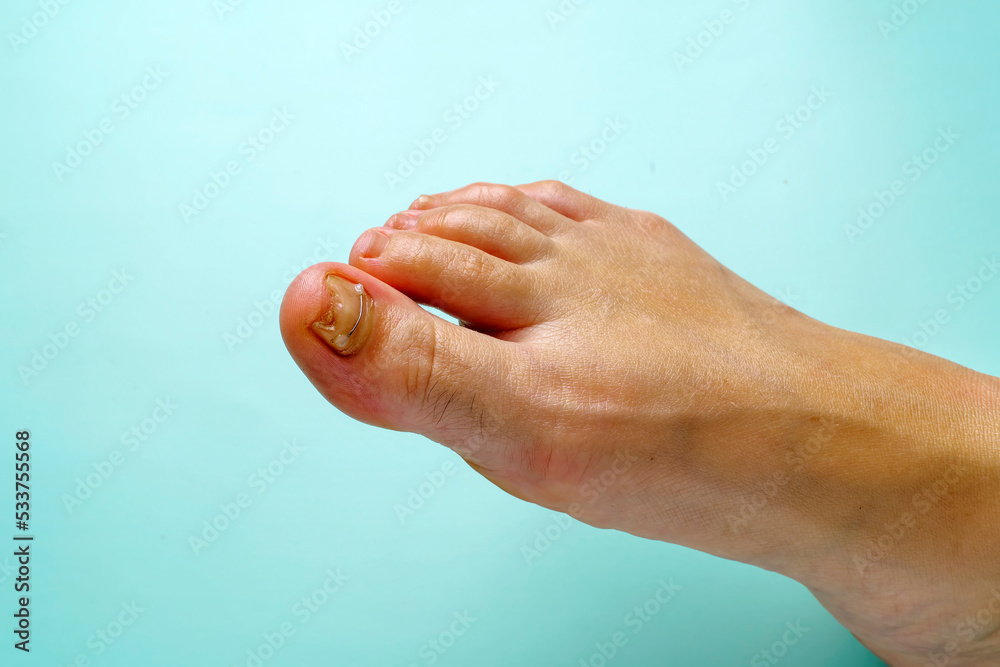 Fungal disease damaged foot nail corrected with titanium thread Stock ...